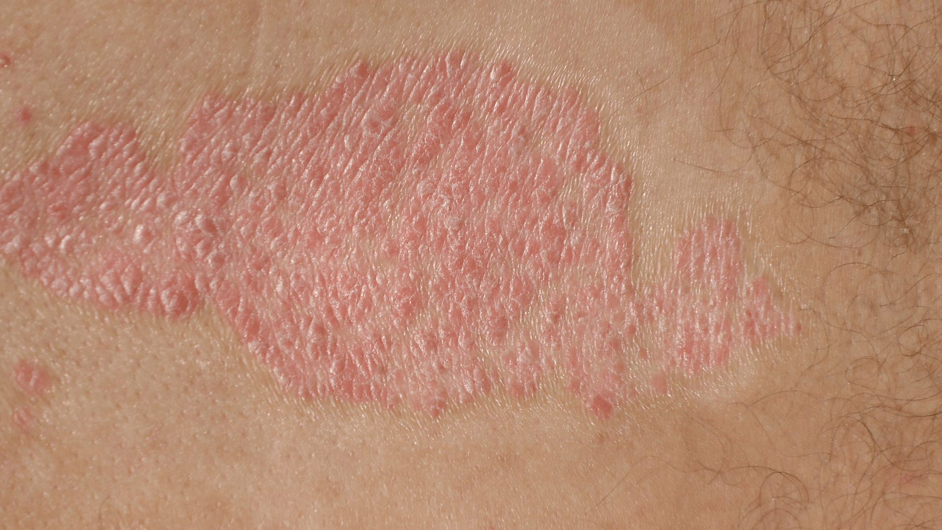 Psoríase - Tratamento Natural - observação clínica por um ...