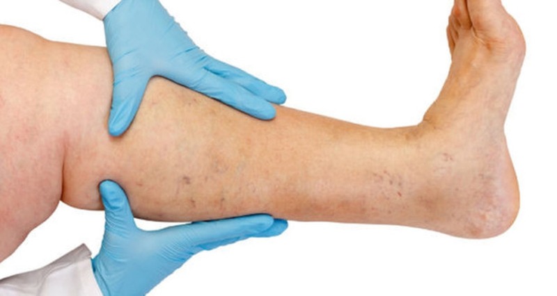 Flebite (tromboflebite superficial) - Causas e Sintomas